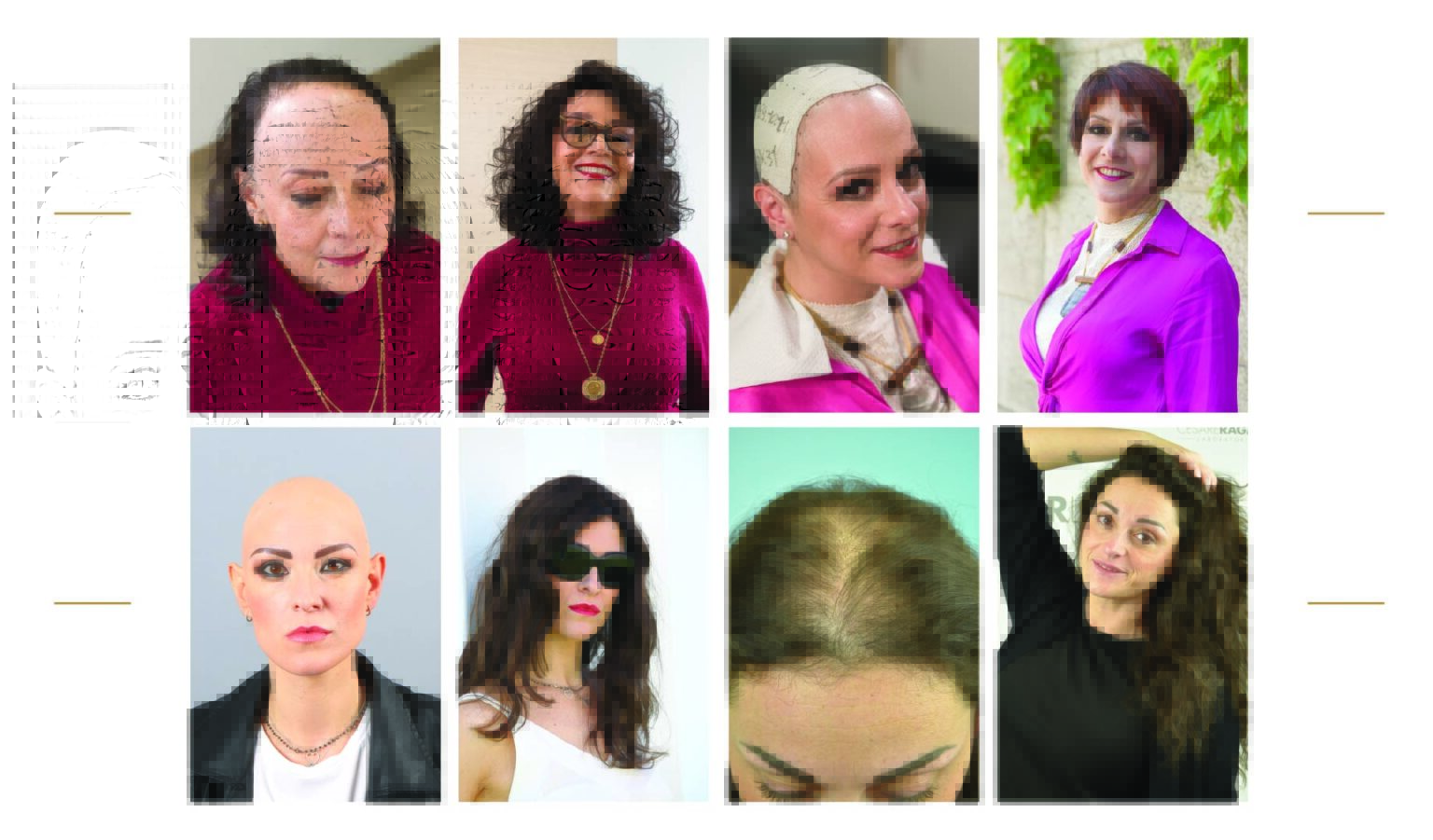 Sistemas de Integración Capilar - Clínica Capilar Madrid I Insparya