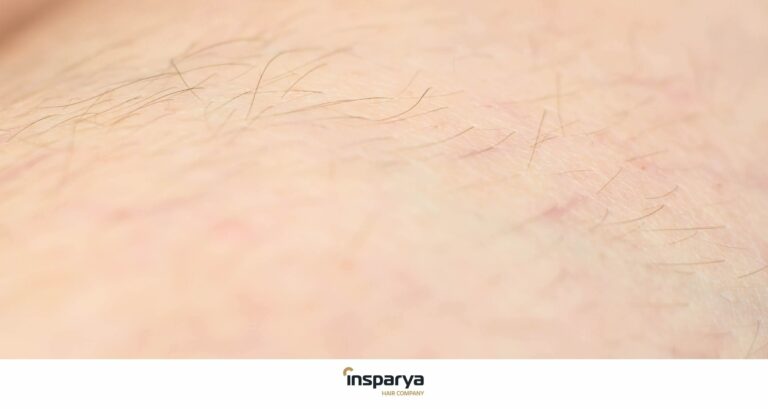 Hirsutism And Hypertrichosis What It Is And It´s Causes